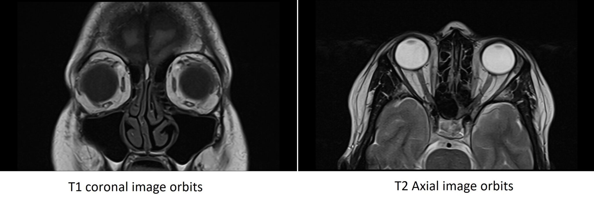Comparative Utility of T1 vs T2 MRI in Imaging Optic Nerve Sheath ...
